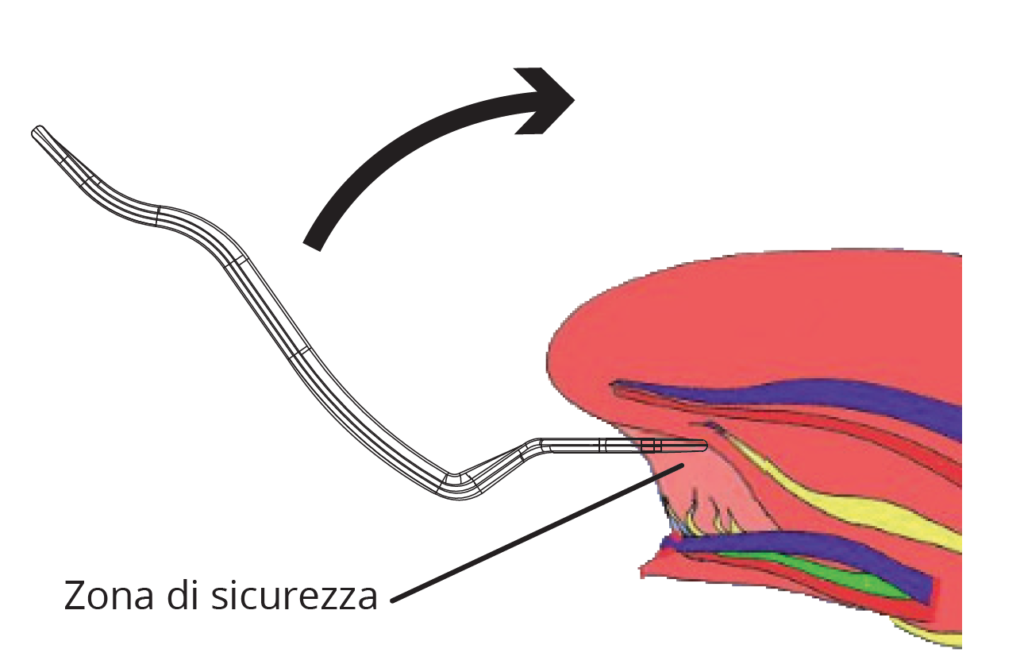 Tongue Lifter - Device for lingual frenulum - Ep medica